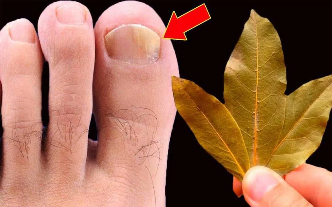 Natural treatment for nail fungus with bay leaf: a simple home remedy ...